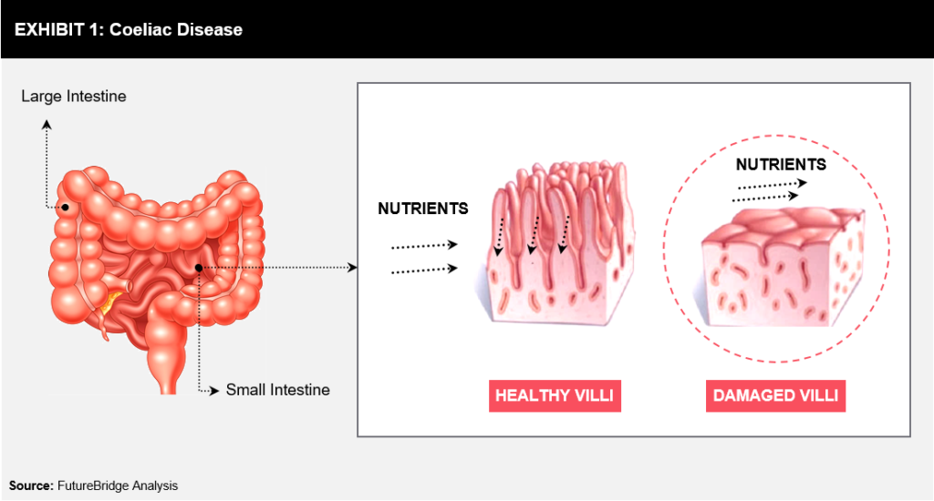 Gluten Intolerance – A Common Sensitivity in Human - FutureBridge